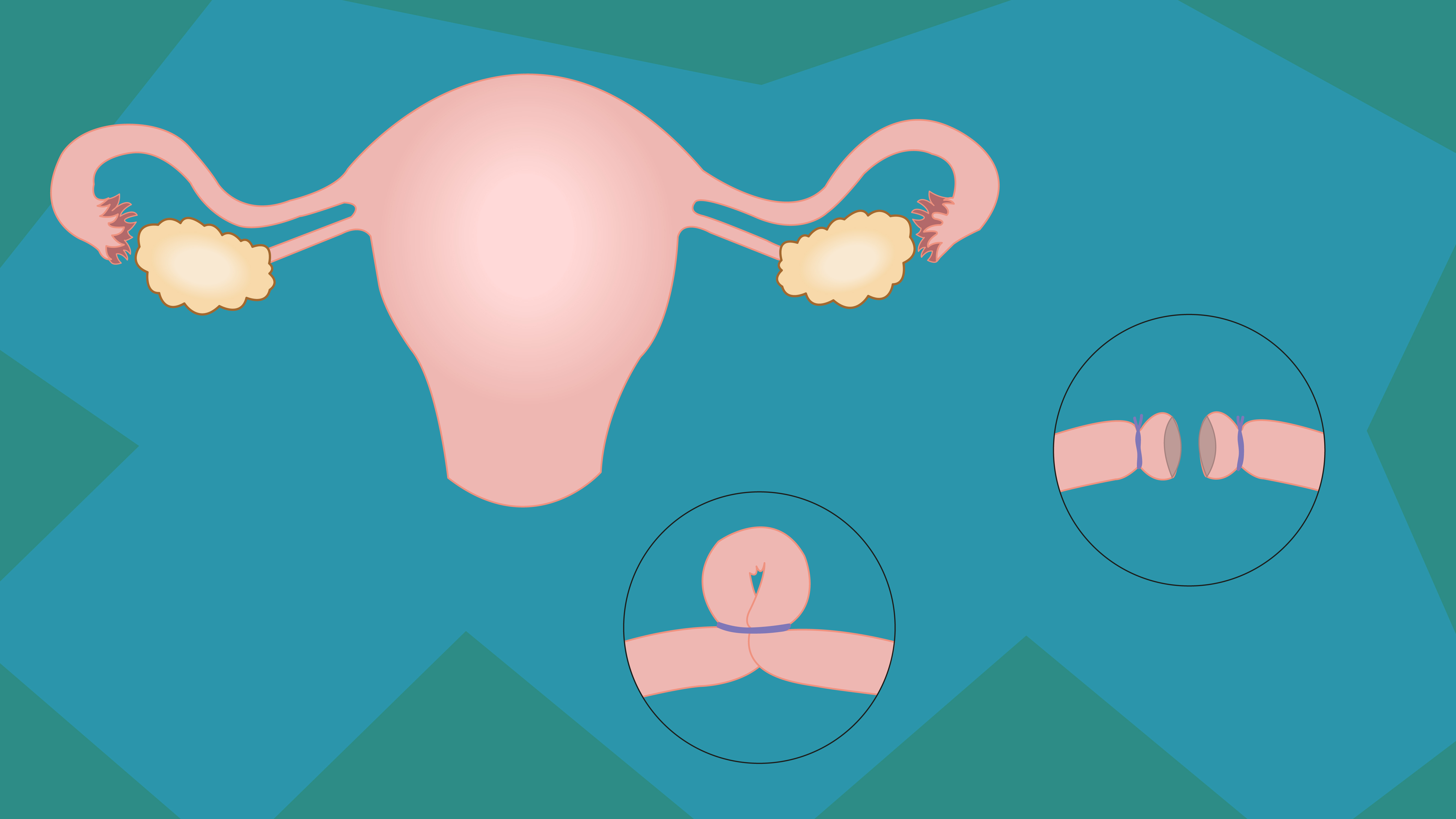 ¿Qué es la Oclusión Tubaria Bilateral? - +Salud FacMed ¿Qué es la Oclusión Tubaria Bilateral? - +Salud FacMed